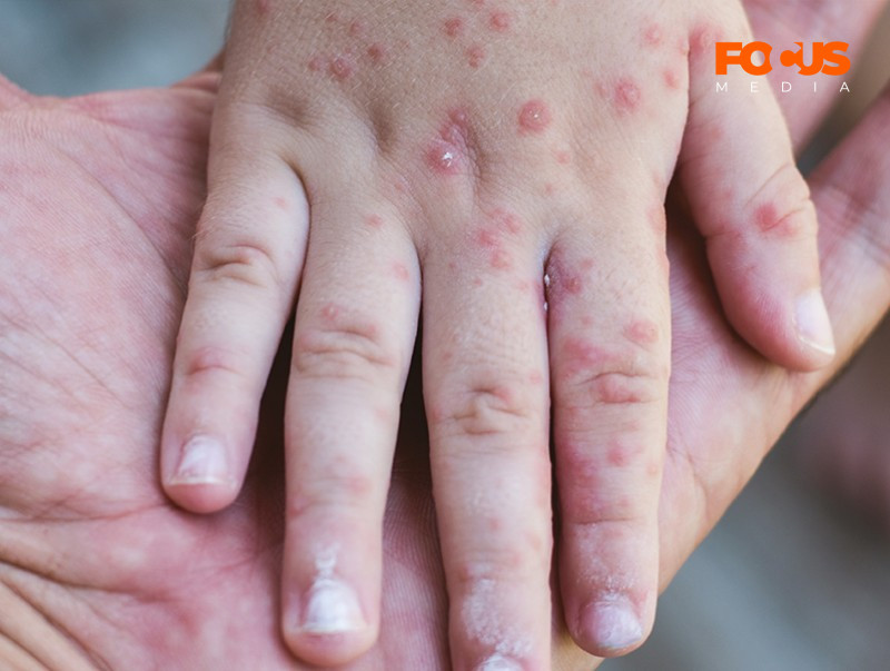 Улаанбурхан өвчний 62 дахь тохиолдол батлагджээ